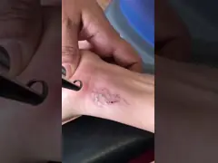 Y6 강력한 Q스위치 Nd 야그 레이저 효과적 귀영 나팔 제거 장치