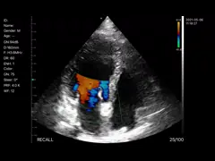 Macchina senza fili di ultrasuono dell'analizzatore 2.2MHz di ultrasuono di modo di doppler B