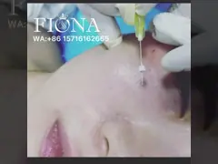 under eye thread lifting treatment remove wrinkles  curing dark  circle