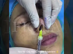 Non Surgical Painless 60mm Cog Thread Nose Lift