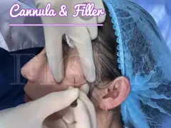 Cannula and Filler