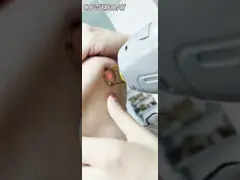 Supplier Dual Wavelength Laser Hair Removal Machine For Remove Tattoos And Pigment