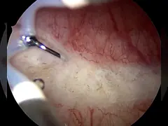 China Gynecological Cold Plasma Probe For Sterilization And Wound Healing Solution for sale