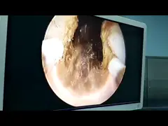 urology bph resection