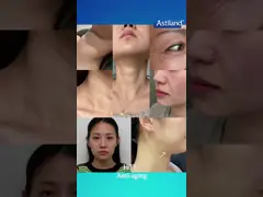 Remarkable effects of HIFU｜Before & After