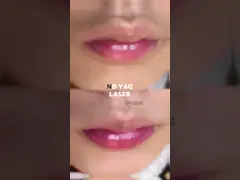 China Laser Pigmentation Removal ND Yag Laser Machine Removal Pigment Spots for sale