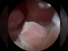 China Sterile Plasma Surgical Device Urology Electrode For Bladder Tumor for sale