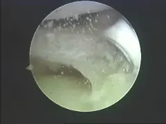 China 90 Degrees Bipolar Plasma Coagulator of Orthopaedics for sale