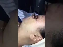 3-in-1 Picosecond Laser Machine - Remove Spots & Tattoos Safely