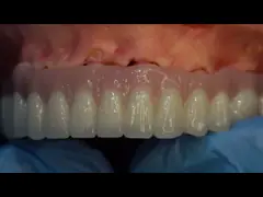 China Zirconia Titanium Dental Implants All On 4 Full Arch Teeth Replacement 3-6 Months Healing Time for sale