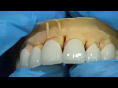 Cina Corone di laboratorio dentale a contorno completo di alta traslucidità Corone di zirconia solida in vendita