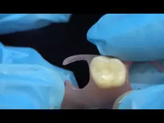 China Dental TCS Valplast Flexible Partial Dentures Nesbit Valplast Finish China Dental Lab Valplast Clasp for sale