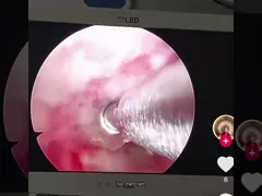 Manual Morcellation Cutter Surgical Power Systems for Intrauterine Solution