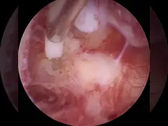 China Ear Probe PLA205 used by ENT physicians Ear Scope for sale