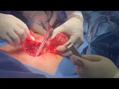 Usando o plasma Forcep para fazer corte e coagulação na cirurgia aberta de ressecção de tumor