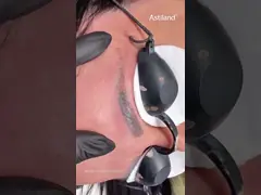 Nd Yag Laser for eyebrow tattoo removal #ndyaglaser #tattooremovallaser #beautymachine #laserclinic