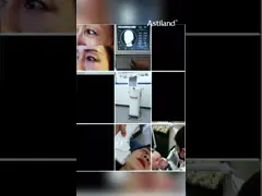 Have You Tried RF+ HIFU for Skin Tightening? #AntiAging #SkinLift #beautyclinic  #facialtreatment