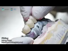 China Composite Pink Porcelain Crown A1 Shade All On 4 Hybrid Titanium Screw Retained for sale