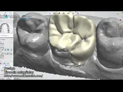 Translucent Onlay Zirconia Inlay For Long Lasting Stain And Wear Resistance