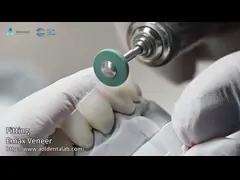 China Dental Lab High Esthetics Translucency EMAX Veneer with 0.3-0.5mm Thickness for Anterior and Posterior Restorations