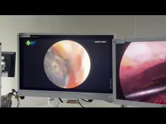 China EVT Medical Multi Directional Stone Retrieval Basket Complex Anatomies Ureteral Stone Basket for sale