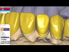 China Hybrid Pink Porcelain Implant Crown Malong Full Arch Implant Bridge Immediate Loading for sale