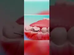 China Long Shelf Life Durable Spacer Springs for Dental Clinics Pre-Banding Procedures in Class II Instrument Classification for sale