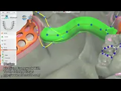 FDA Vitallium Framework With Tooth Colored Clasps For Natural Esthetics