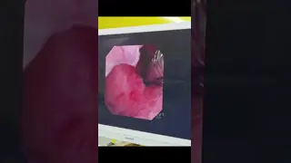 Antegrade Ureteral Stent Placement | Under Direct Vision