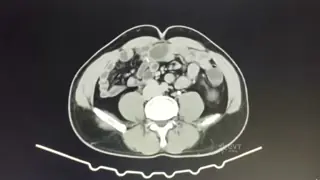 Facing Bilateral Complex Ureteral Stenosis: A 54-Year-Old Male's Clinical Journey