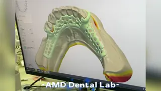 Cast Partial Denture