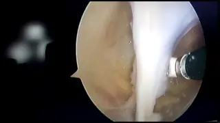 High Efficiency Multi Needle Plasma Electrode For Shoulder And Knee Soft Tissue Ablation