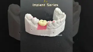 All Zirconia Implant Crowns Bridges High Quality Aesthetics