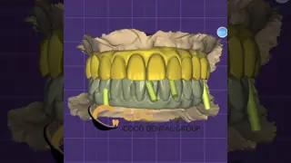 Zirconia Implant Restorations Stronger Dentures