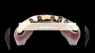 Malong Bridge Implant Bar Precision Dental Restoration