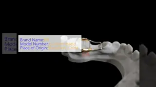 Pediatric Dental Space Maintainers Tooth Alignment