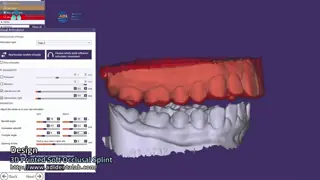 Custom 3D Printed Splint for Bruxism Comfort