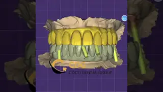 China Dental Lab All-On-X Restorations