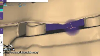 China Dental Lab Precision Restorations