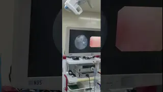 New Progress | EVT Ureteral Stent System Used in First Complex Ureteral Surgery at Chang'an Hospital