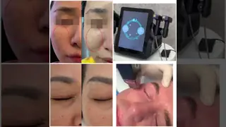 Before-and-After treatment effect of microneedle RF machine