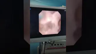 The Flexible Negative Pressure Sheath — The Ureteroscope’s “Perfect Duo”