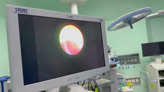 EVT Ureteral Stent System
