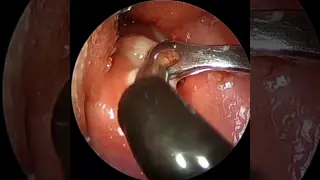 ENT Probe