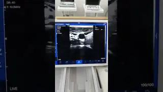 Palm Sized Wireless Ultrasound for Precise Needle Guidance