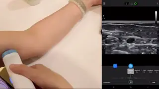 Golead linear ultrasound probe for basilic vein