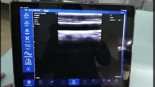 Wireless Linear Ultrasound Scanner for Precision Guidance