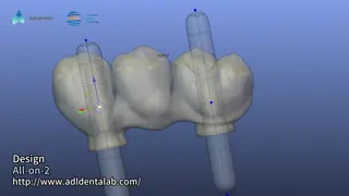 Premium Titanium Implant Bar for All On X Dentistry