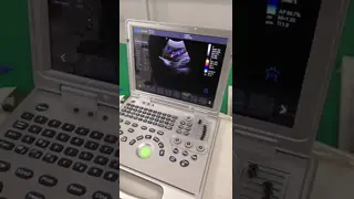 US15 Plus 2D Portable color doppler machine