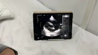 Dual Head Wireless Ultrasound Probe for Cardiac and POCUS